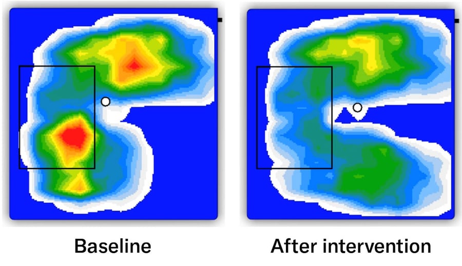 Pressure mapping: a method to investigate persistent pressure injuries