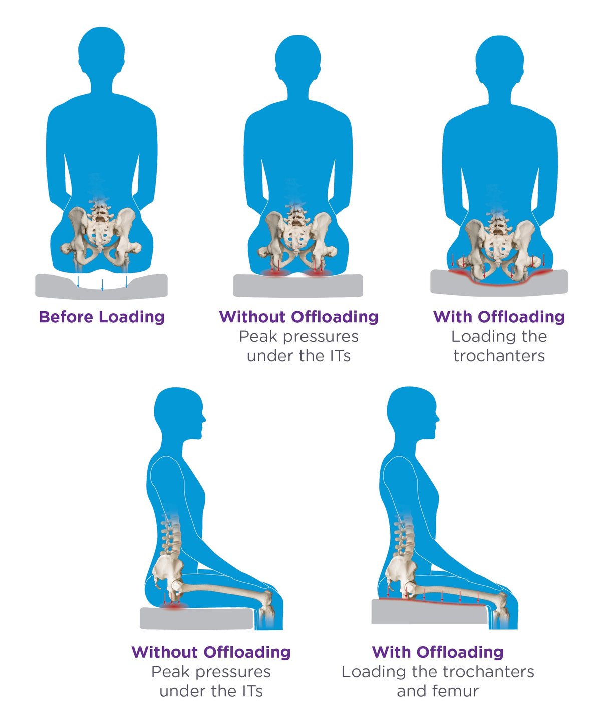 Offloading vs Immersion: Wheelchair Cushions for Pressure Injuries