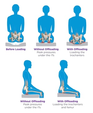 Offloading vs Immersion: Wheelchair Cushions for Pressure Injuries