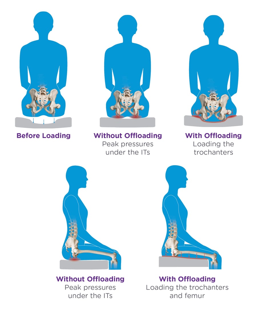 Offloading vs Immersion: Wheelchair Cushions for Pressure Injuries