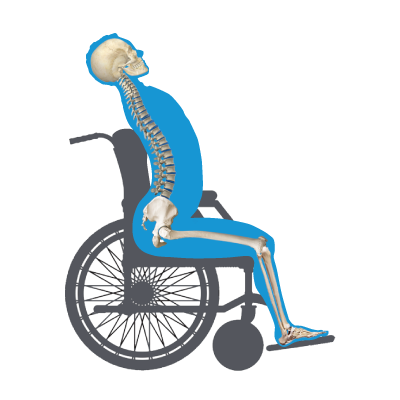 Posture Problems: How proper wheelchair positioning can prevent ...