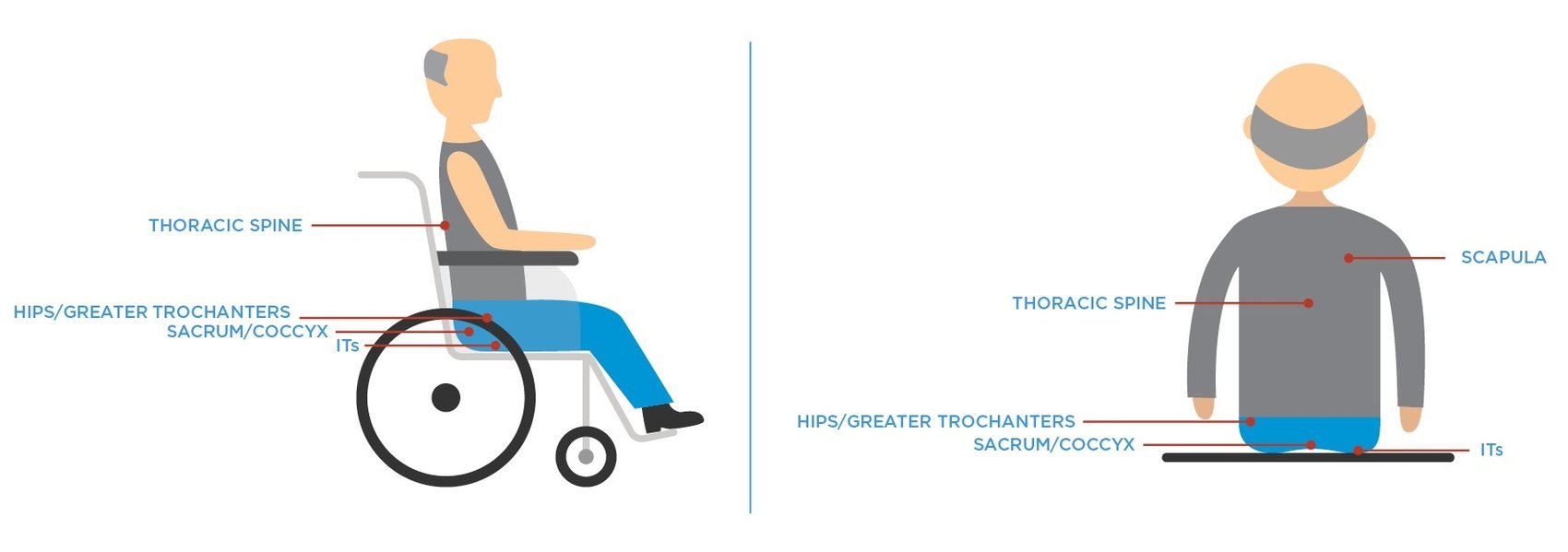 Prolonged Pressure: A Key Factor in Wound Development