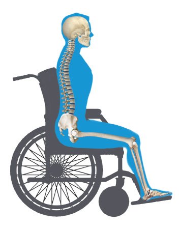 The Common Postural Abnormalities Seen in Wheelchair Seating and ...
