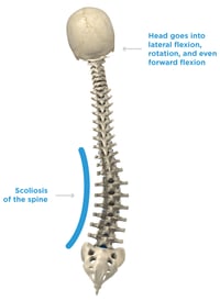 Recognizing a Windswept Deformity During a Mat Evaluation