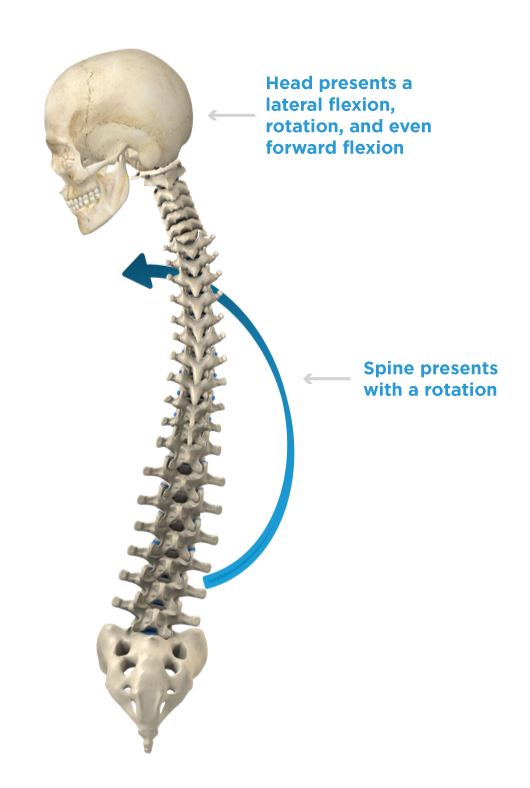 Recognizing a Windswept Deformity During a Mat Evaluation