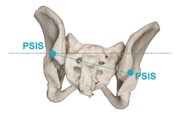 Recognizing a Windswept Deformity During a Mat Evaluation