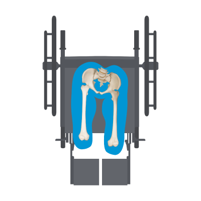 The Common Postural Abnormalities Seen in Wheelchair Seating and ...
