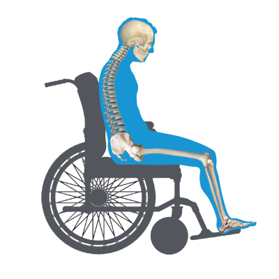 The Common Postural Abnormalities Seen in Wheelchair Seating and ...