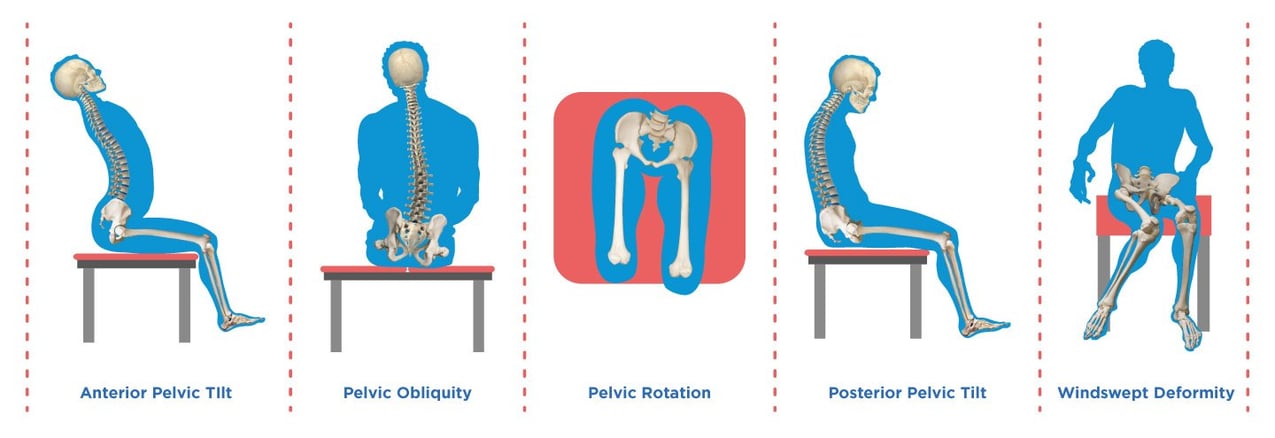 Postural Evaluation in Sitting: Let Your Hands Mimic the Possibilities