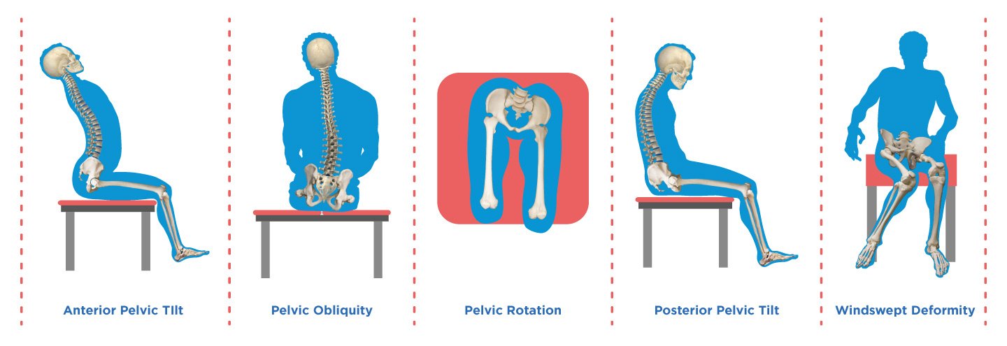 Postural Evaluation in Sitting: Let Your Hands Mimic the Possibilities