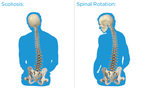 Windswept Posture: Symptoms and treatment through wheelchair positioning
