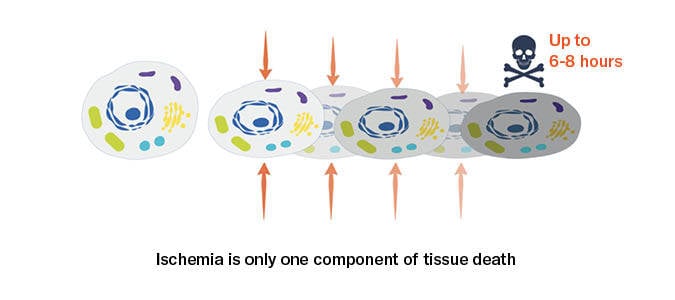 How Pressure Injuries Develop: The Role of Deformation in Cell Death