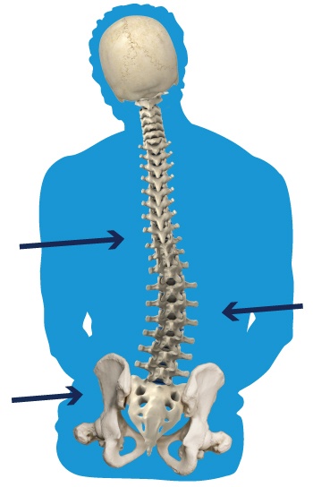 Clinical Applications and Justification for Lateral Trunk Supports